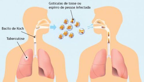 Módulo 1 - Formas clínicas da tuberculose, transmissão e principais ...