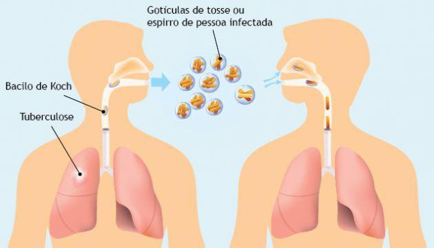 Módulo 1 - Formas clínicas da tuberculose, transmissão e principais ...